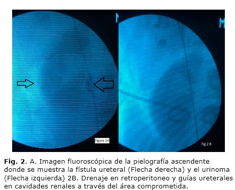 Manejo mínimamente invasivo de fístula ureteral y urinoma ...
